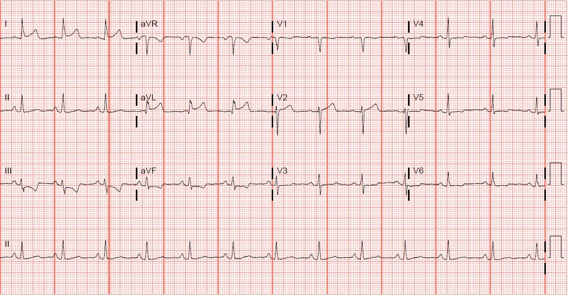 ACLS review: Acute Coronary Syndromes Part 5