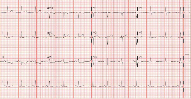 ACLS review: Acute Coronary Syndromes Part 5