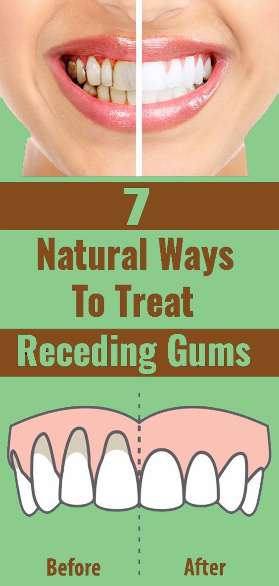 Treat Receding Gums Naturally Using These Methods | Healthy Group