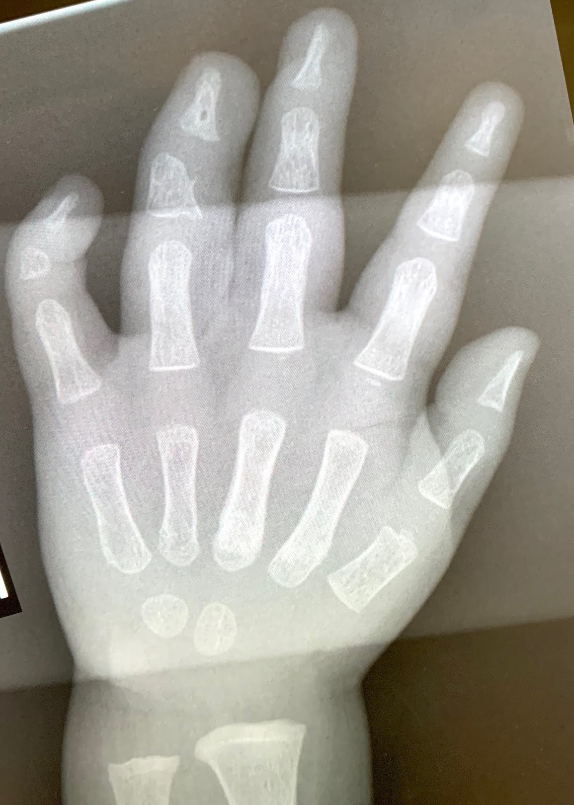 Syndactyly: The Type Matters. | Congenital Hand and Arm Differences ...