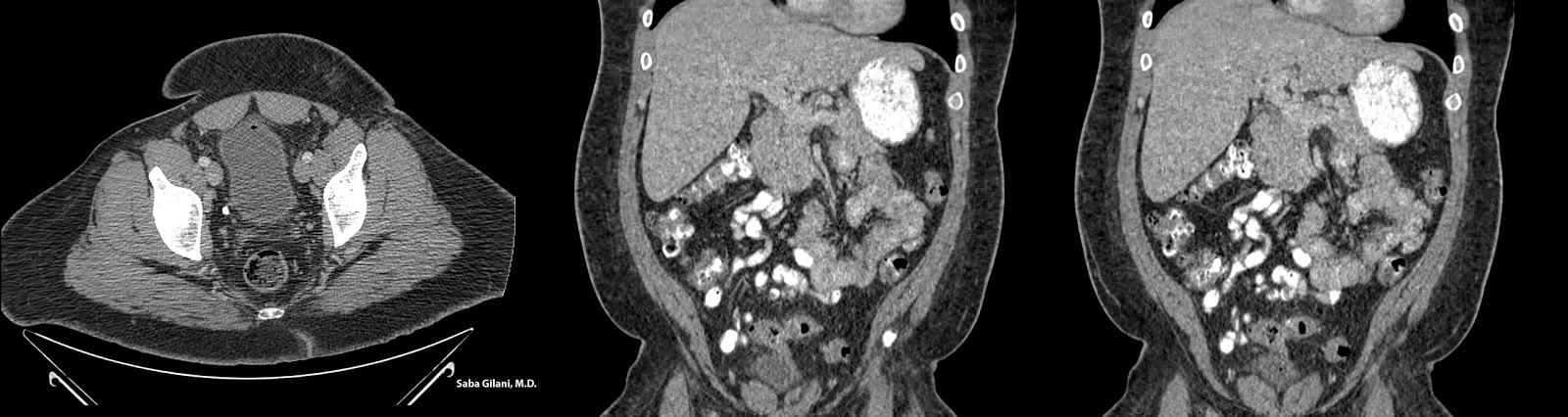 Roentgen Ray Reader: Colovesicular Fistula