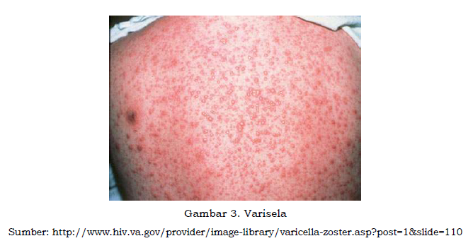 Varisela ~ Panduan Praktik Dokter di Fasilitas Pelayanan Kesehatan Primer