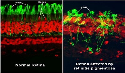 FISIOLOGÍA DE LA RETINA: Distrofia de conos y bastones