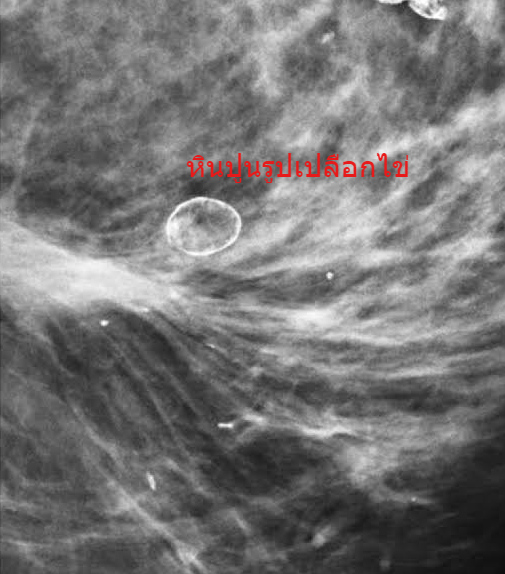 DrRattawachIR: หินปูนในเต้านม (Breast calcifications)