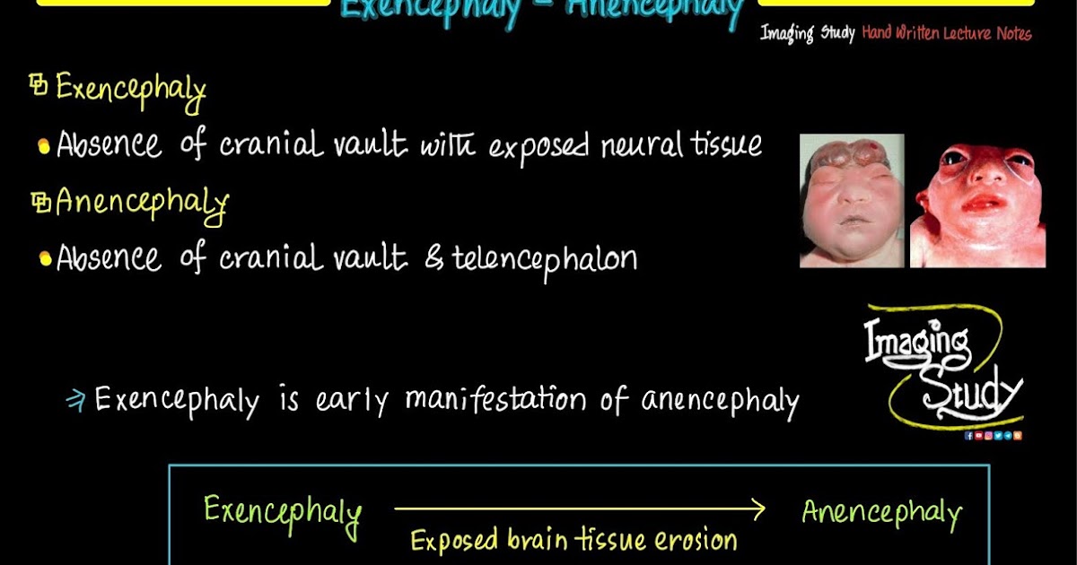 Exencephaly - Anencephaly ~ Imaging Study