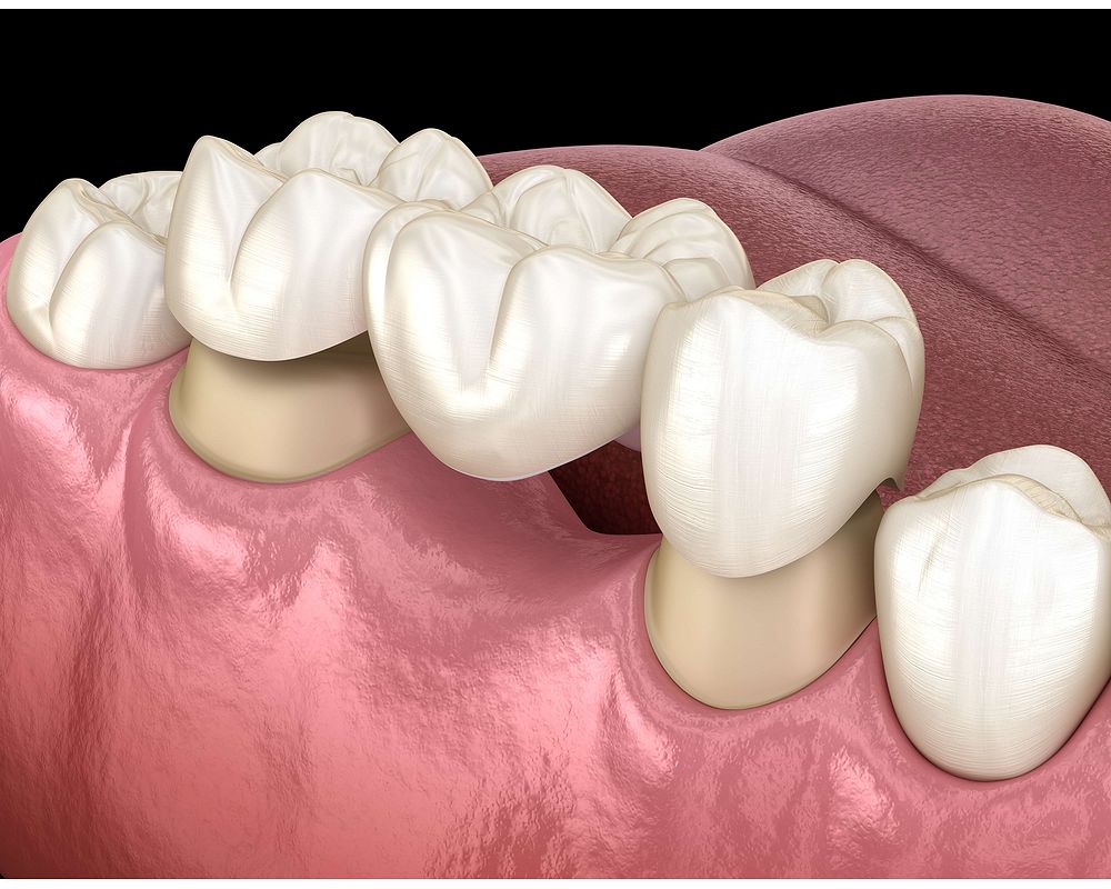 What is a Dental Bridge? - OdontoVida