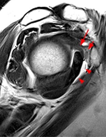 MRI Musculo-Skeletal Section: Coracoid bursa.