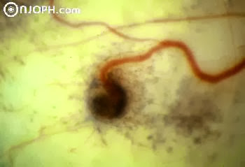 There's a Bump on My Eye Part 4: Nerve Loop of Axenfeld - Eyedolatry
