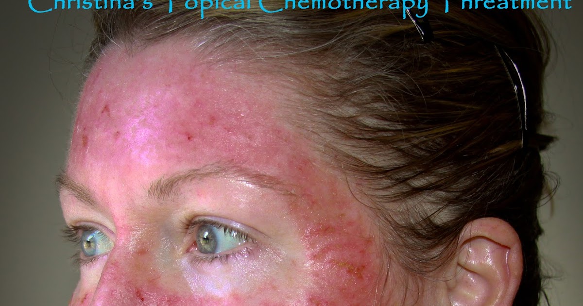 My Journey Through Topical Chemotherapy - Fluorouracil 5% Cream and ...