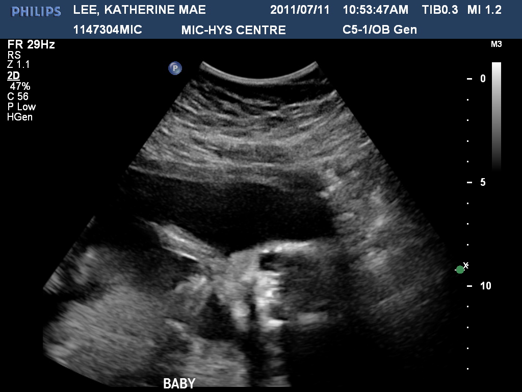 Kate & Nate: Parents In Waiting: 21 Week Follow-up Ultrasound