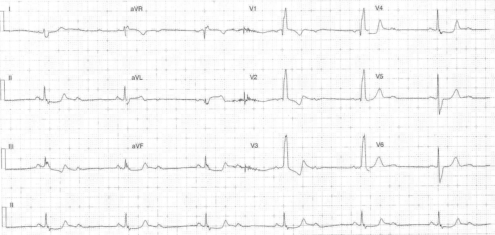ECG of the Week: ECG of the Week - 12th June 2017 - Interpretation