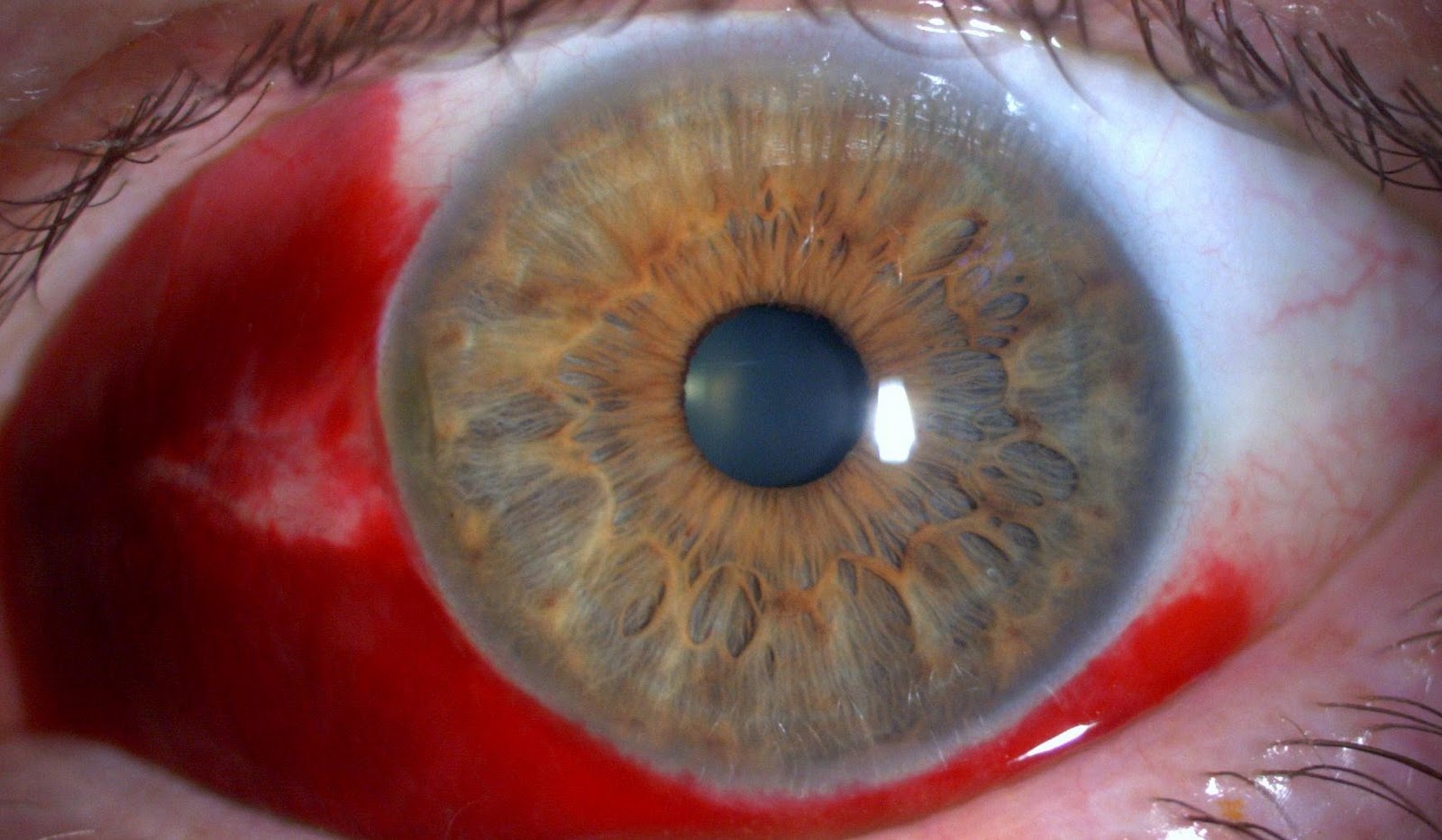 Dr. Armando Ramírez Huber OFTALMOLOGO: Alerta Roja ante un Ojo Rojo