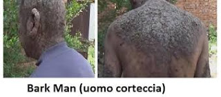 A man whose skin is as thick as bark of a tree-psoriasis