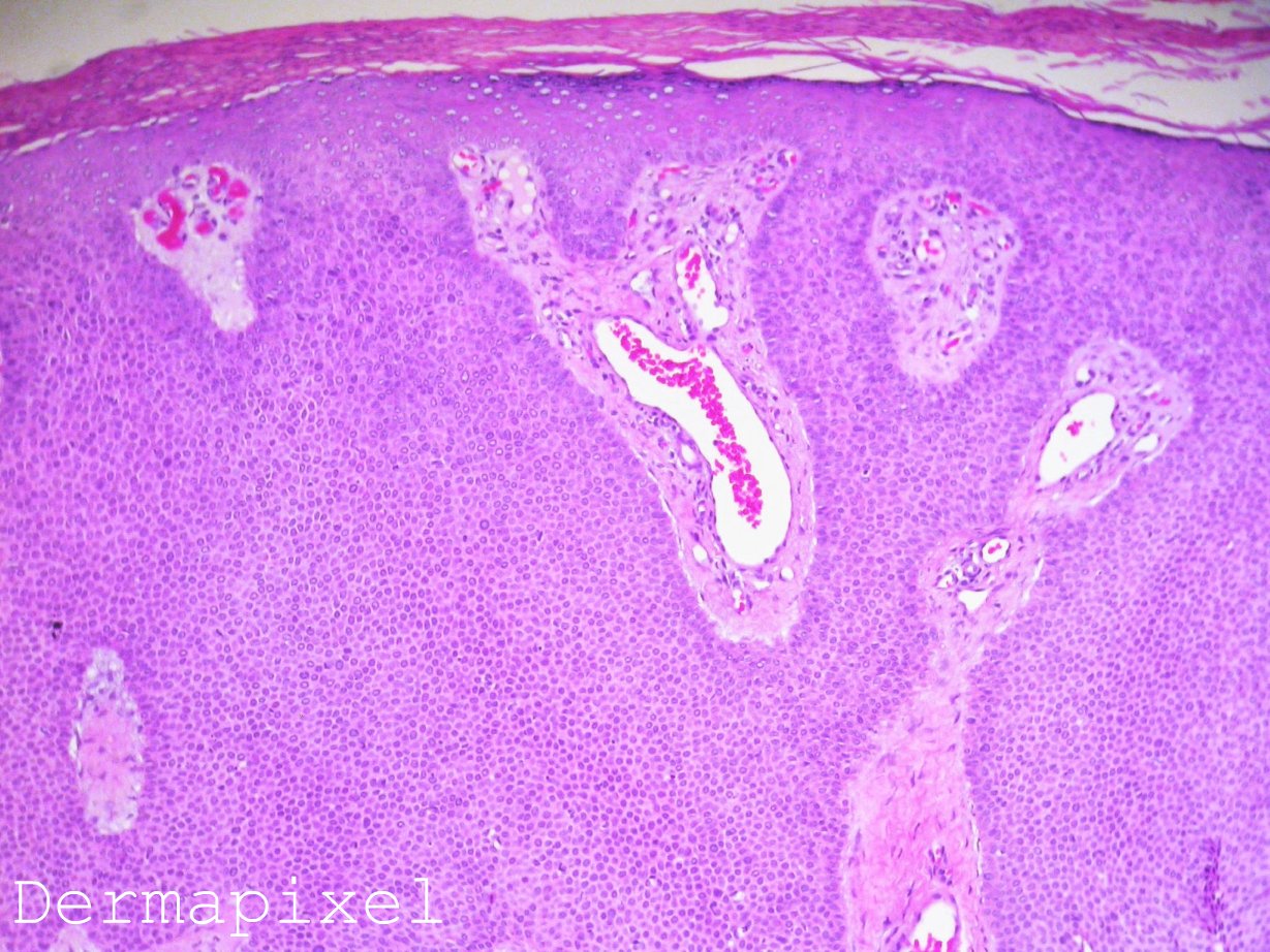 Dermapixel: junio 2013