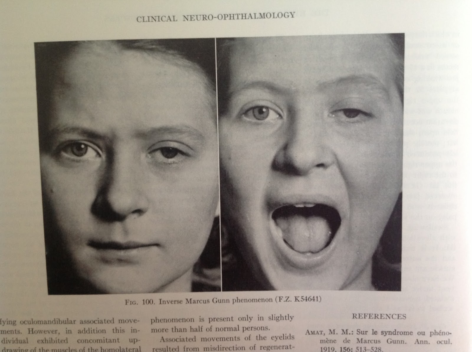 HIGH HISTORY OF MEDICINE: EL SÍNDROME DE MARIN-AMAT O FENÓMENO DE ...