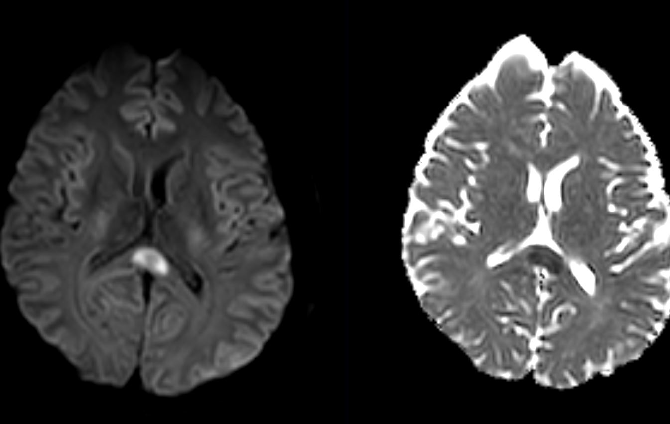 Cytotoxic Lesions Of the Corpus Callosum (CLOCCs)