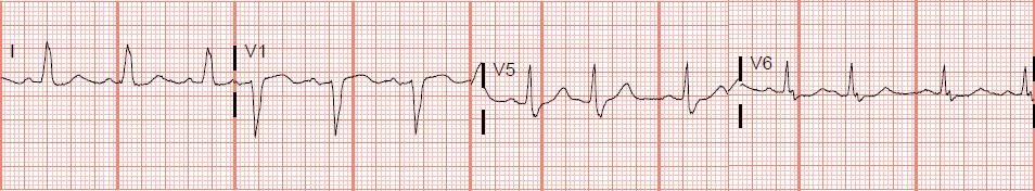 Bundle Branch Blocks Part 1