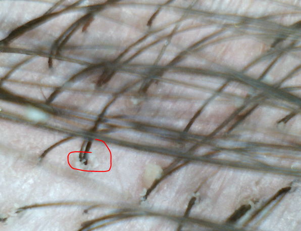 mi cuero cabelludo al microscopio :) - Recuperar El Pelo - Foro sobre ...