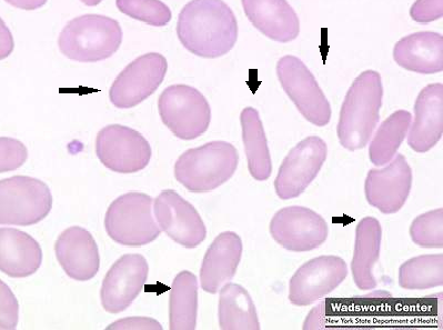 Atlas de Hematología : Eliptocitos.