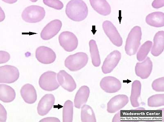 Atlas de Hematología : Eliptocitos.