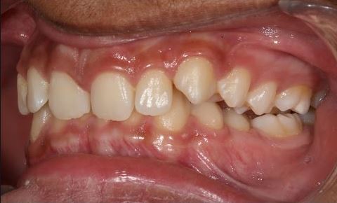 Class II division 2 Malocclusion in Orthodontics