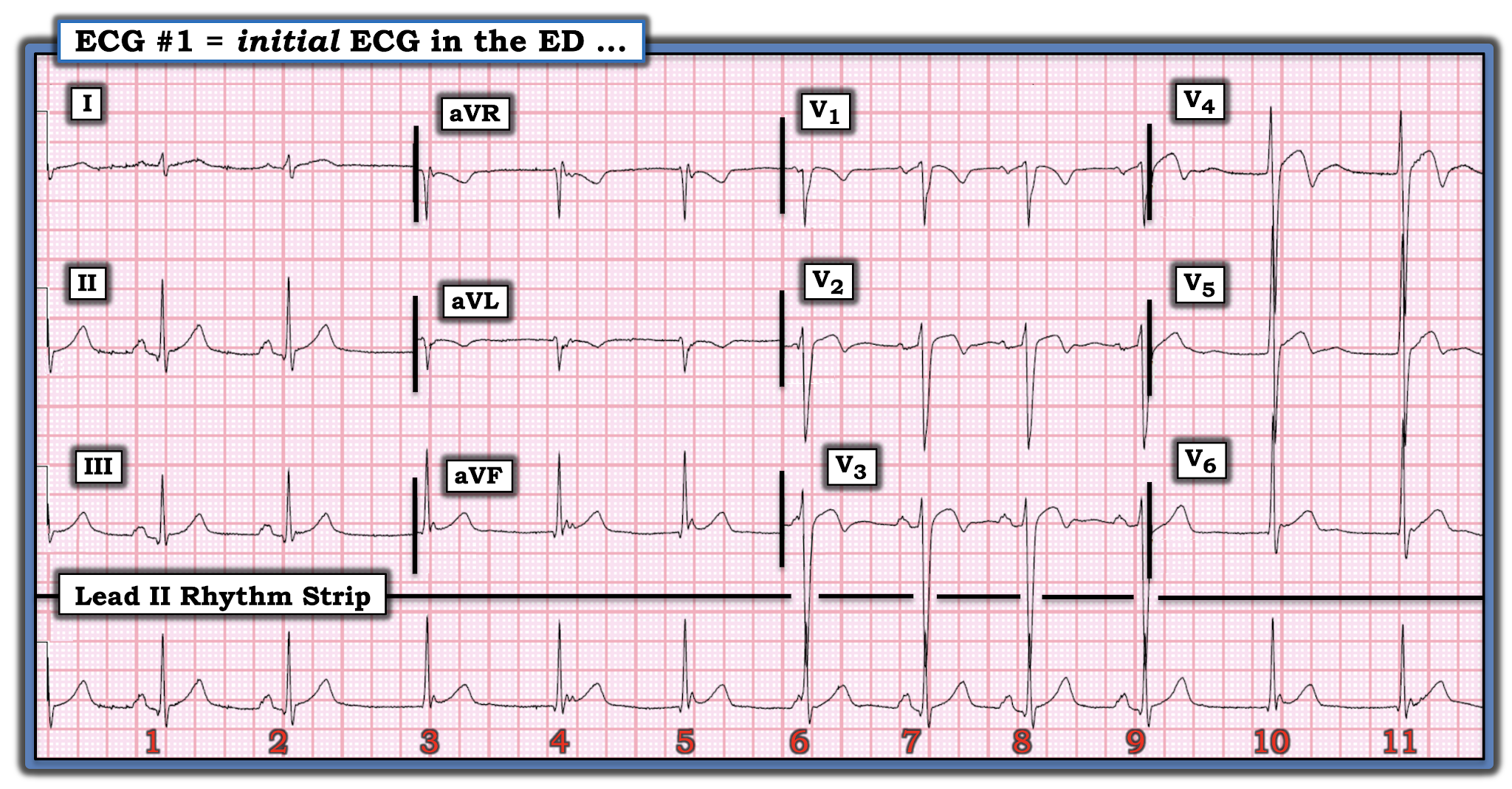 Dr Smiths Ecg Blog Not All New T Wave Inversion Signifies Ischemia Also What Is This