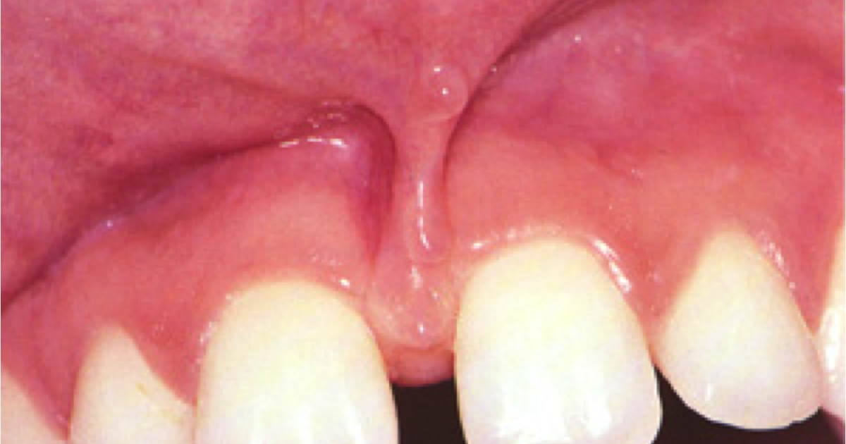 Reason To Smile: All you need to Know about Frenal Attachments in the ...