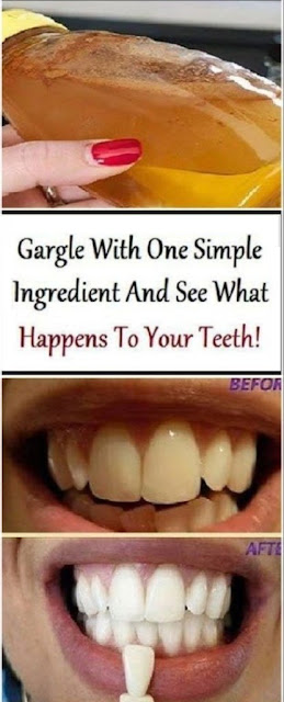 Gargle With One Simple Ingredient And See What Happens To Your Teeth ...