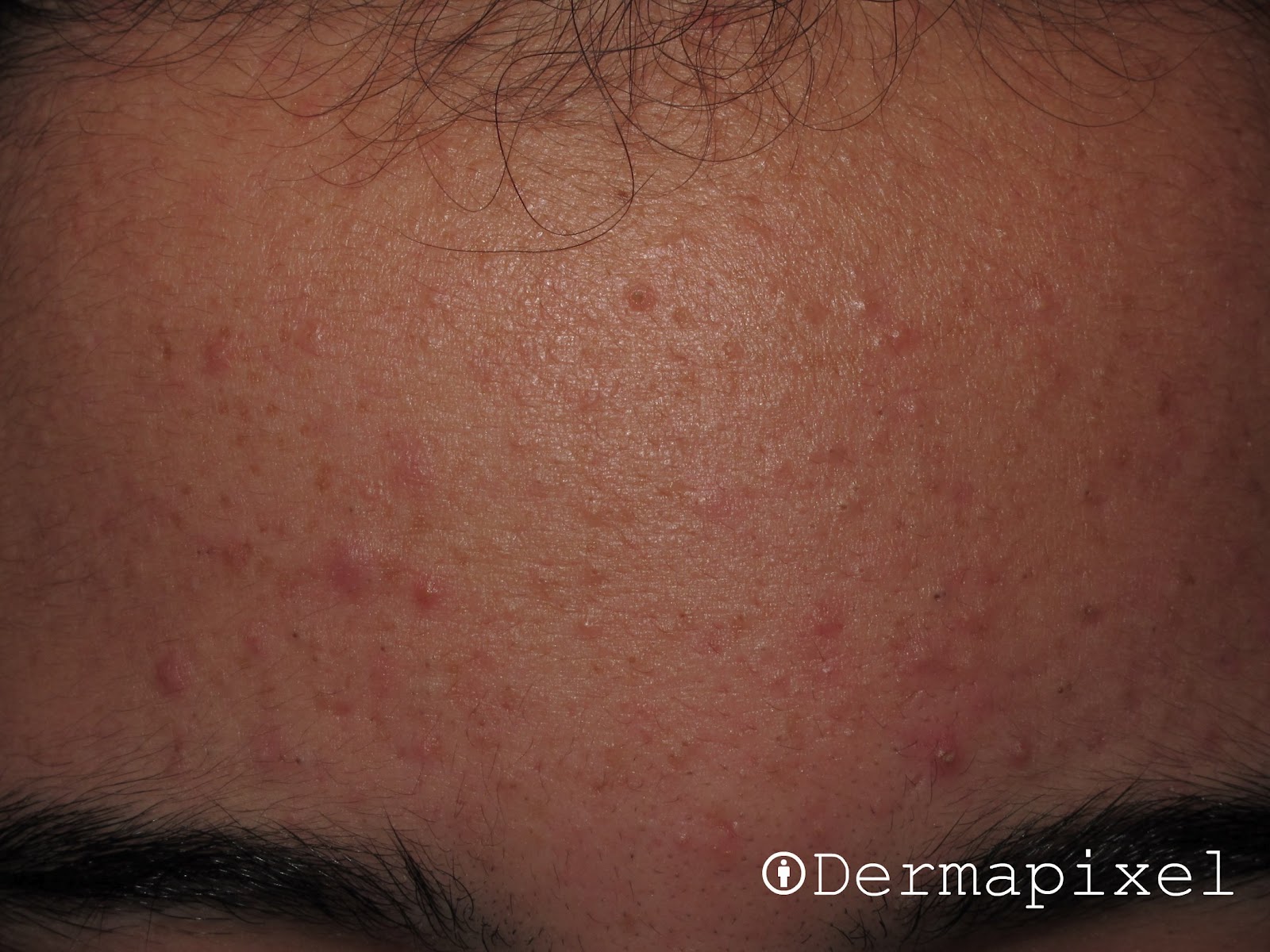 Dermapixel: abril 2012