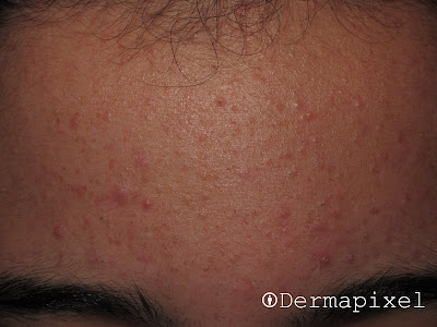 Dermapixel: abril 2012