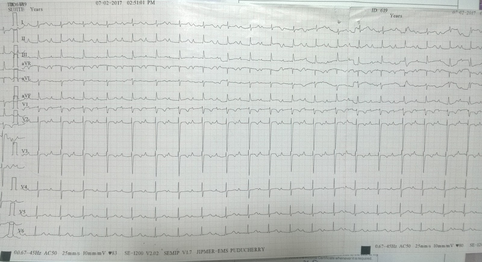 Cardiology window: Congenital heart block