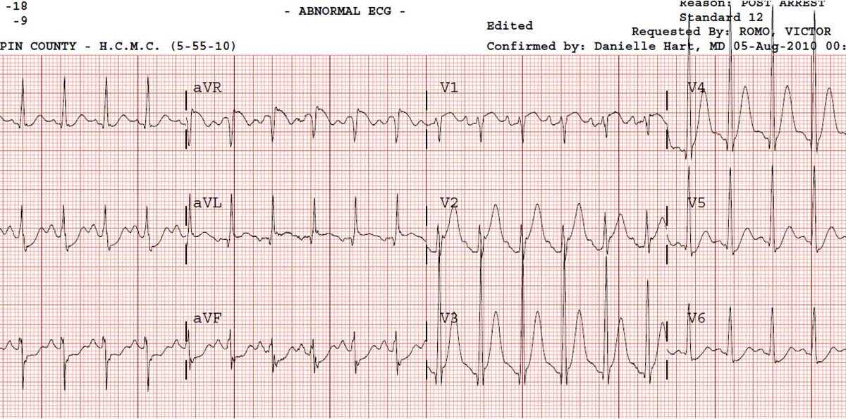 Dr. Smith's ECG Blog: Anterior Hyperacute T-waves diagnostic of LAD ...