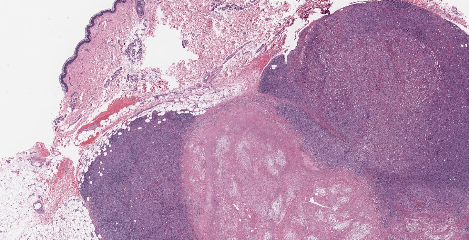 Differential Diagnosis in Dermatopathology: Clear cells