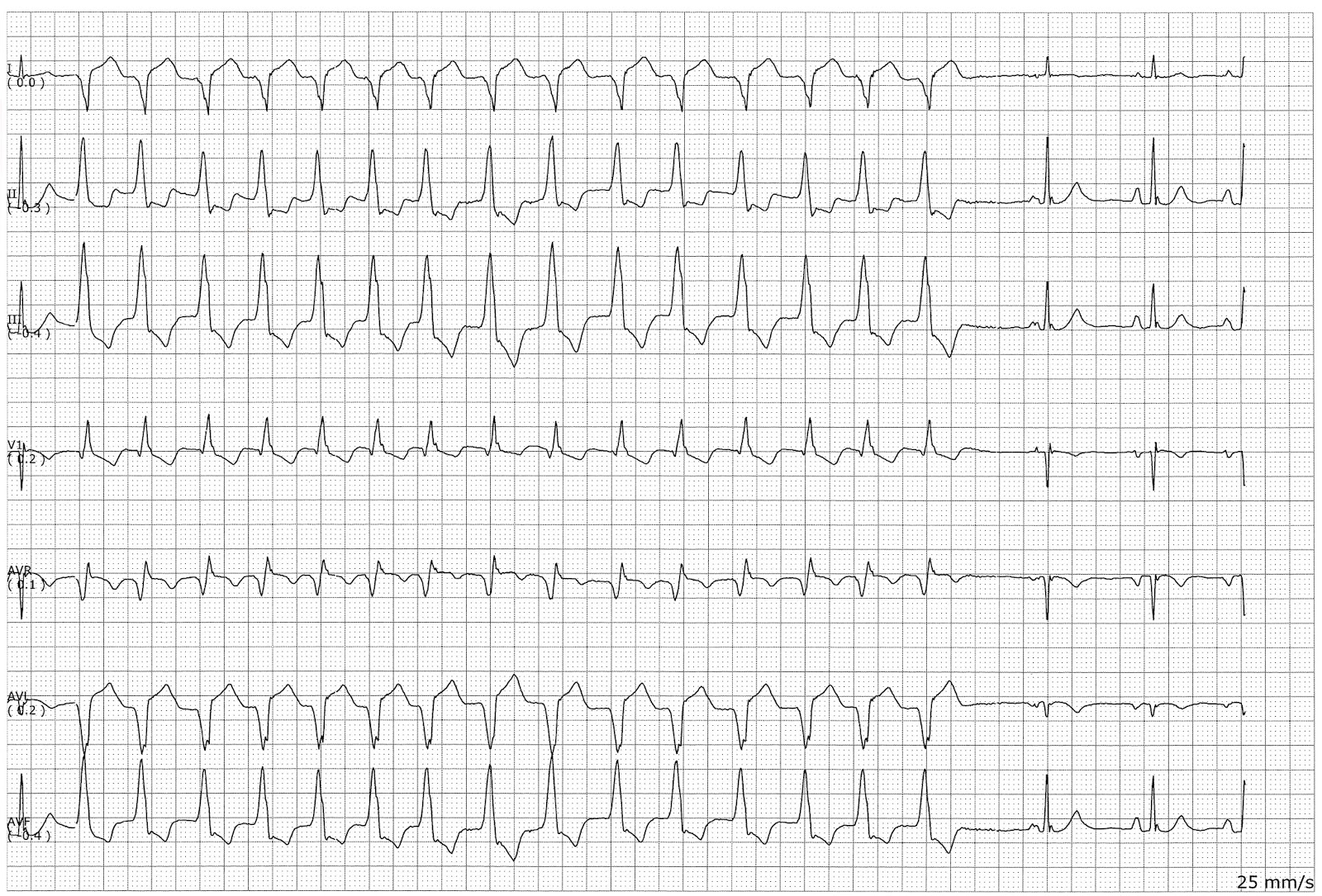 Float Nurse: Sinus rhythm with a run of VT
