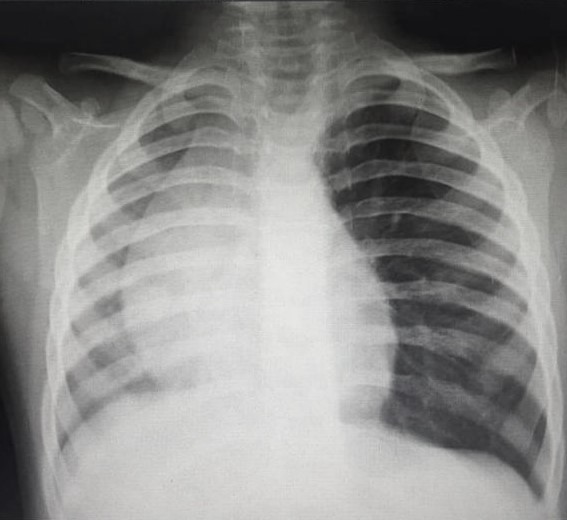 Foreign Body Inhalation : CXR - Sumer's Radiology Blog