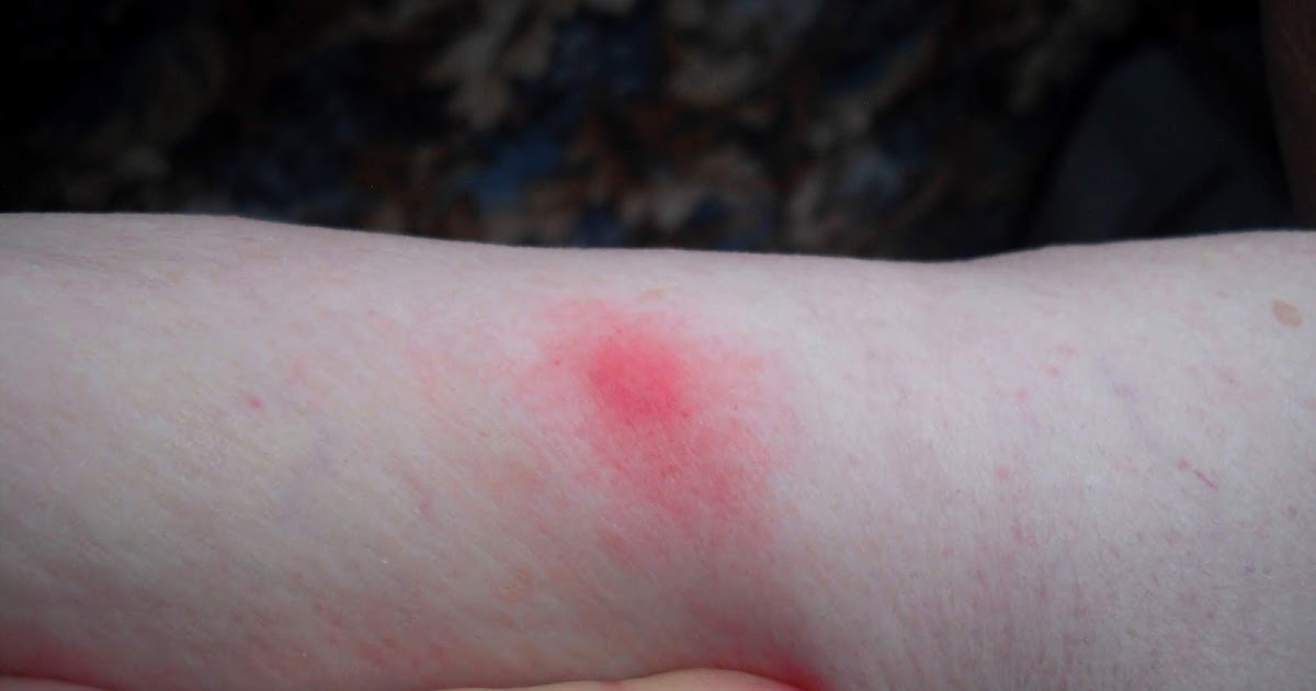 Love my life: Itchy scratchy leg