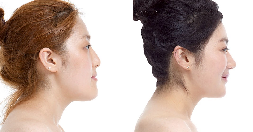 Plastic Surgery in Korea : What's the ideal shape of cheekbones?