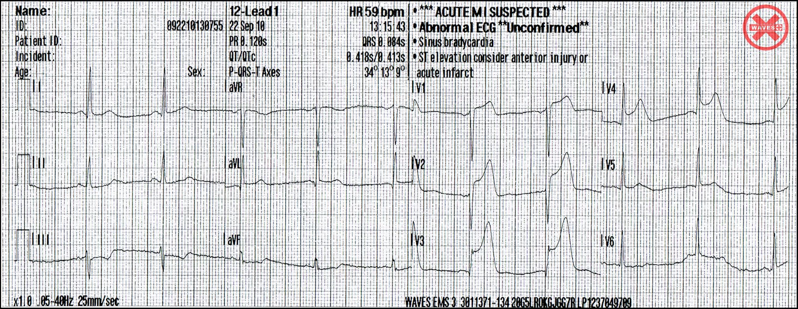 WAVES Ambulance: STEMI Recognized and Treated by WAVES Paramedics
