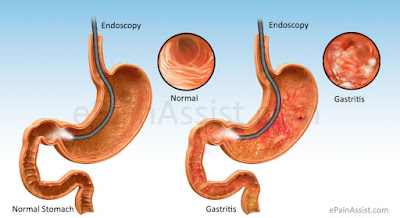 Info Kesehatan: SAKIT MAAG
