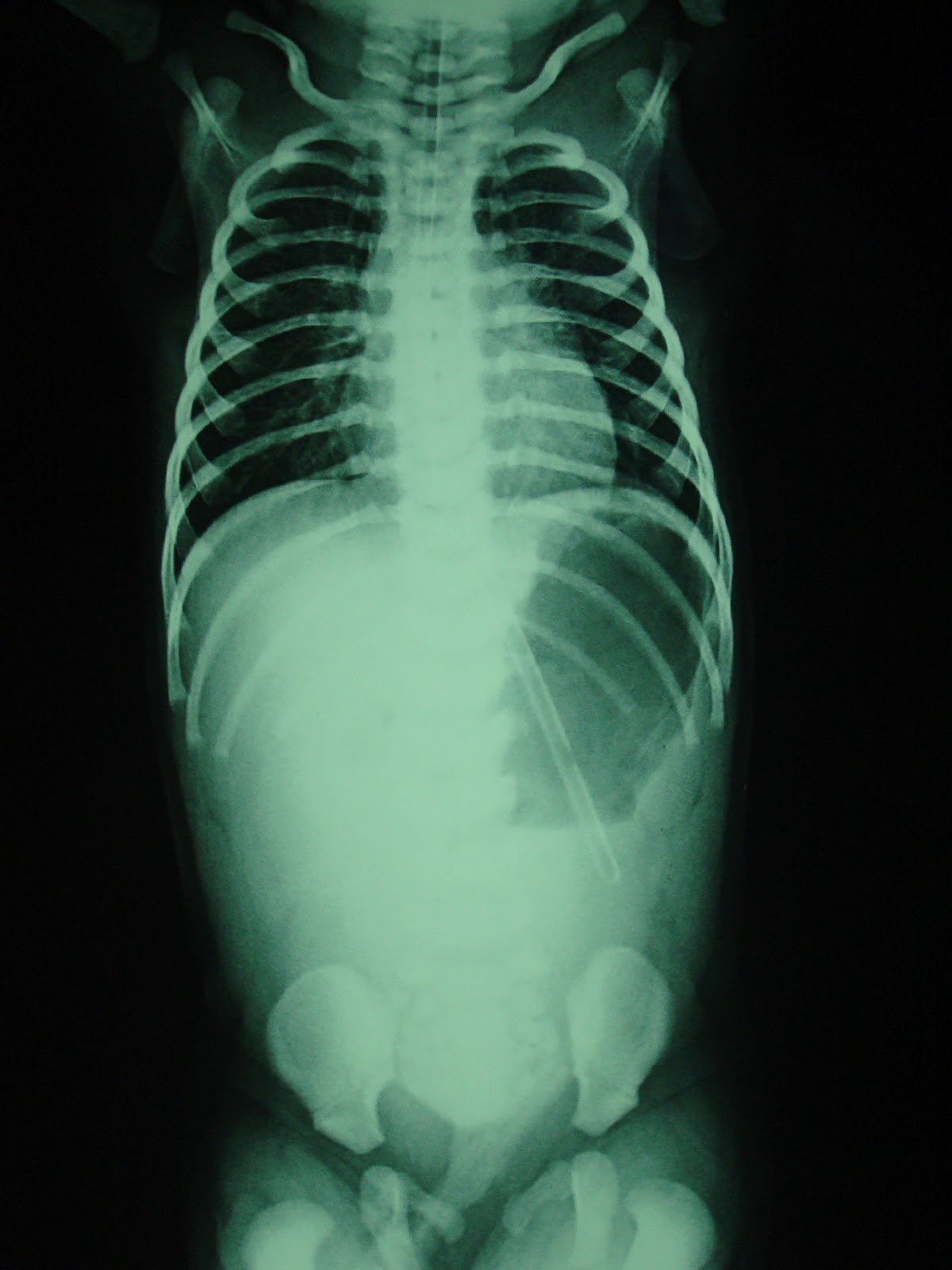 Double Bubble Sign - Sumer's Radiology Blog