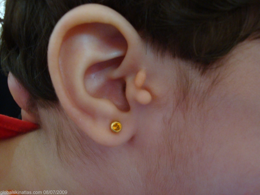 ENT for medical students: ENT PICTURES - EAR