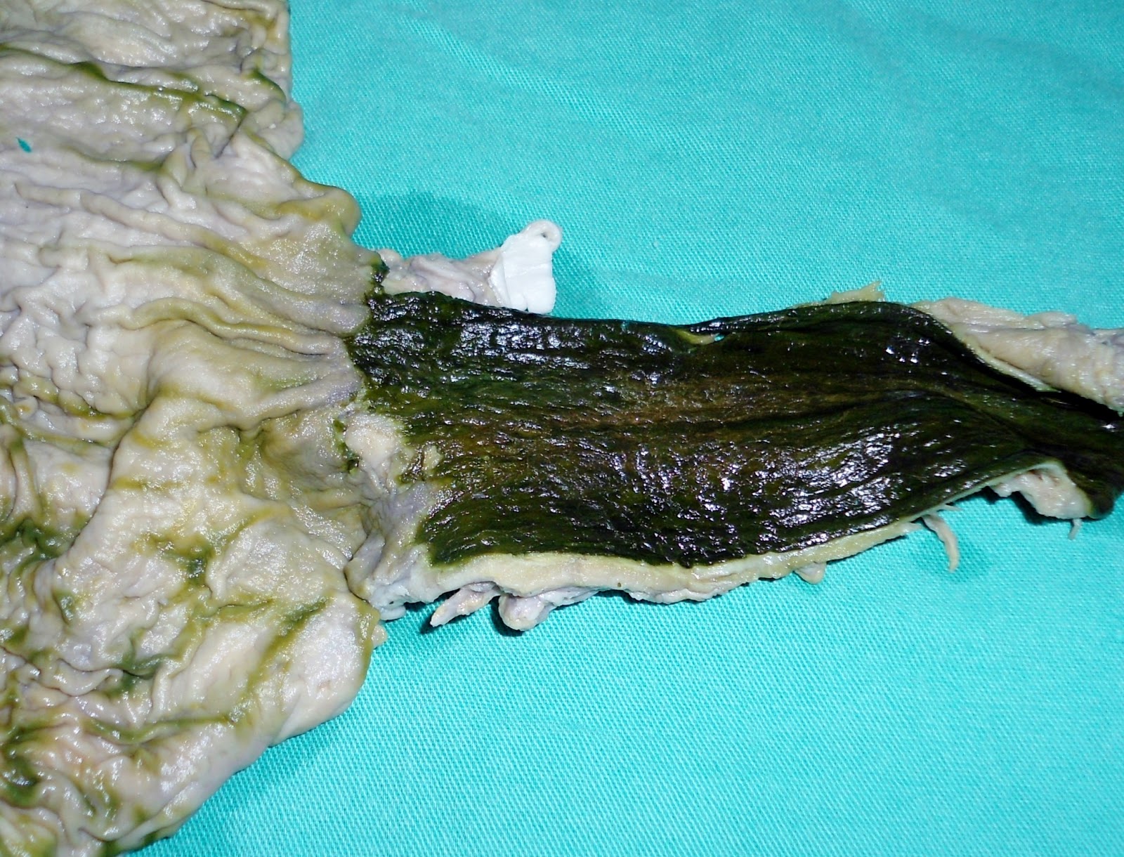 Liga de Patologia - UFC: Esofagite Necrosante Aguda (Black Esofagus)