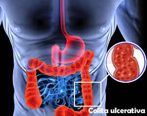 Colita ~ Tratamente naturiste