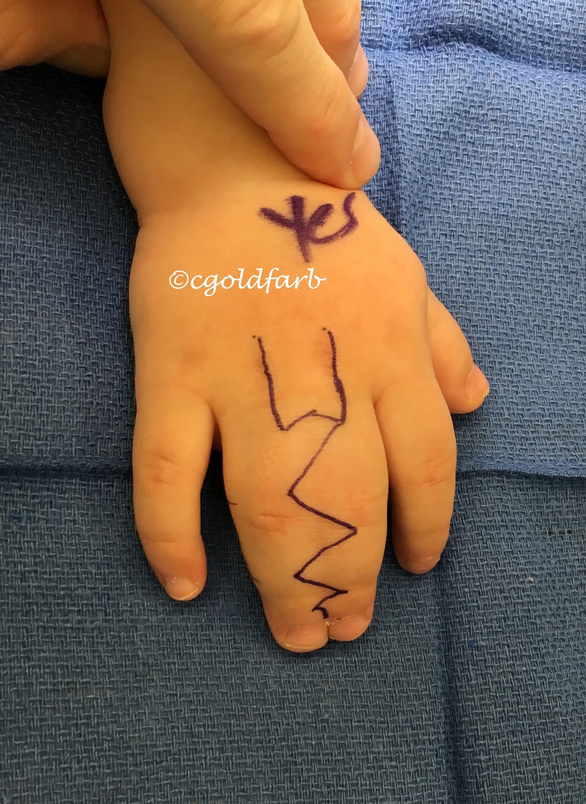 Separating joined fingers: A Case Demonstration of a New Strategy ...