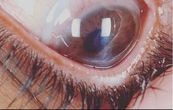 Keratoconus Is Much More Prevalent Than We Thought - Eyedolatry