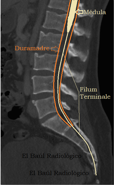 El Baúl Radiológico: LIPOMAS DEL "FILUM TERMINALE": HALLAZGOS EN TC y ...