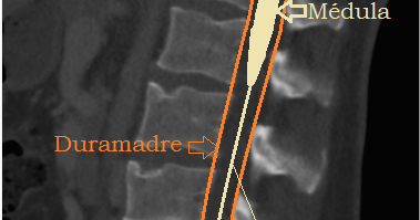 El Baúl Radiológico: LIPOMAS DEL "FILUM TERMINALE": HALLAZGOS EN TC y ...