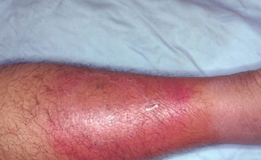 Continuing Professional Development For Management Of Cellulitis After Insect Bites By Nick