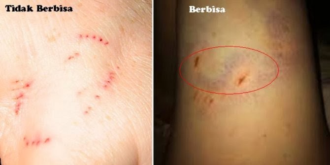 Materi Gigitan Binatang