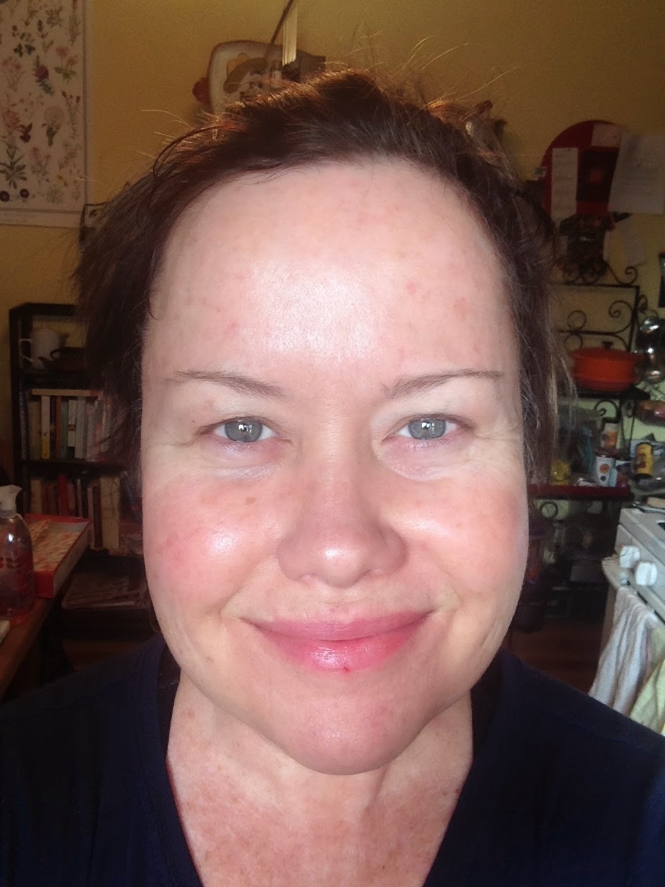 Efudex (Fluorouracil) Adventure: Efudex Days 1-9